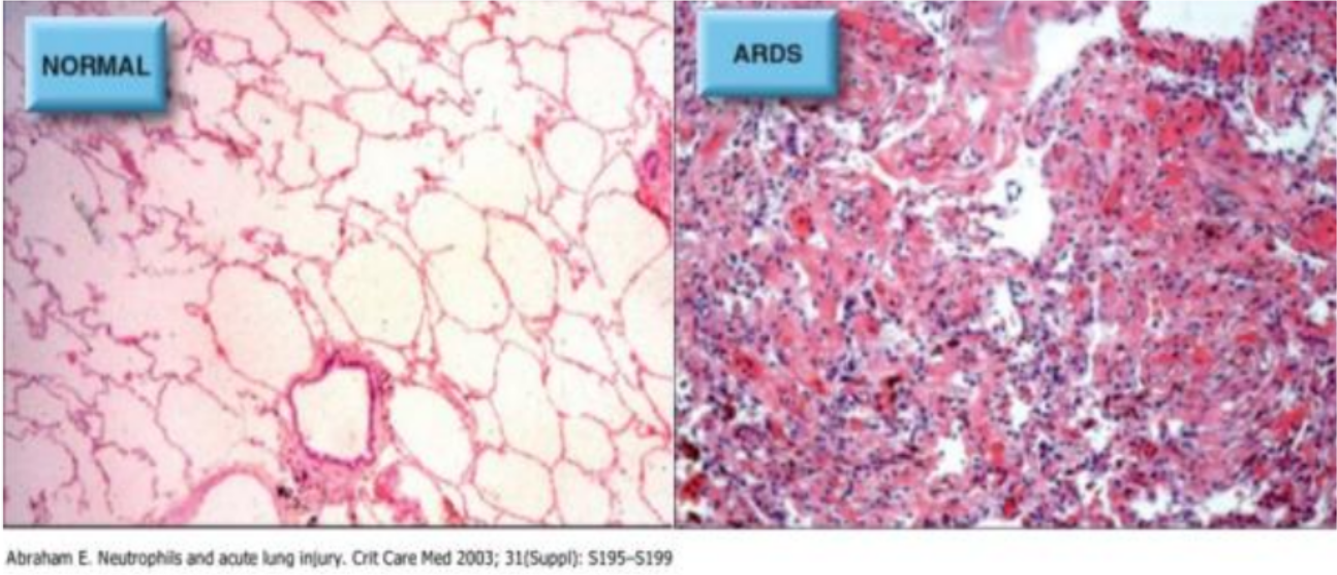Acute Respiratory Distress Syndrome - Loud & Clear: EMS guiding principles