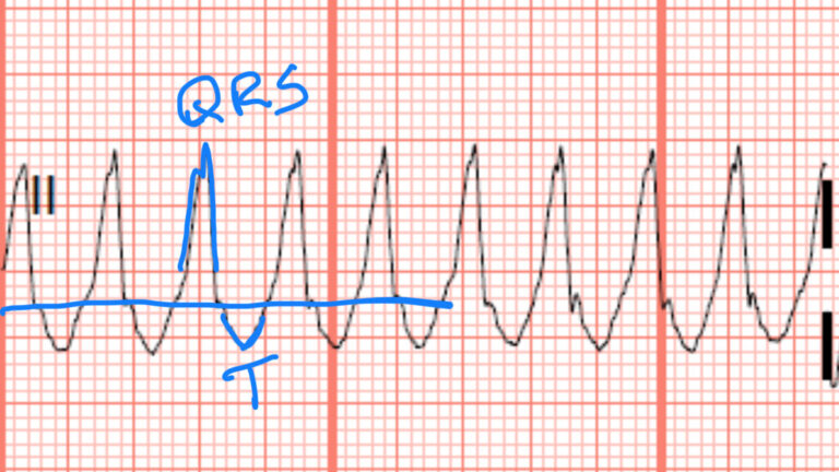Wide Complex Tachycardia: Get Comfortable With Uncertainty - Loud ...